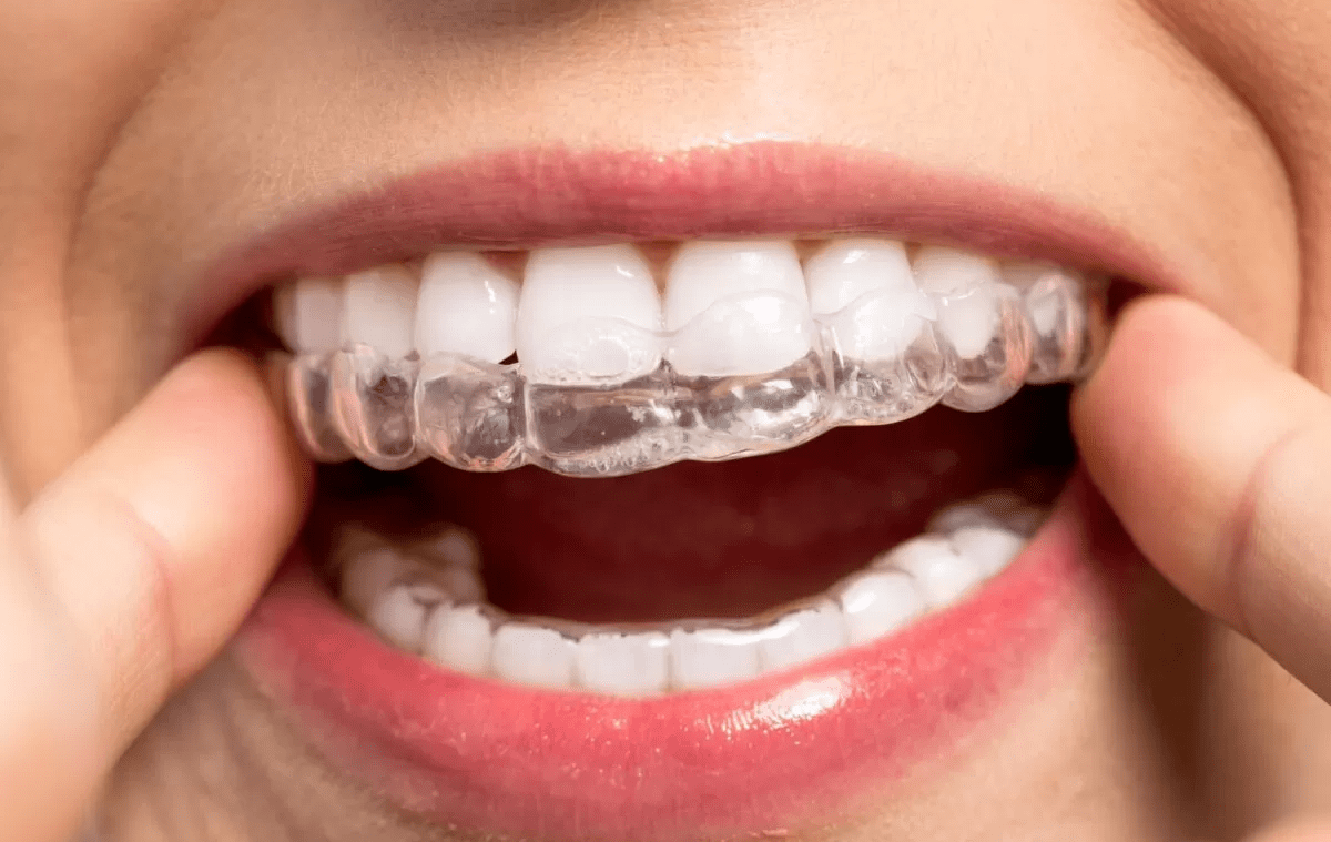 Invisalign Attachments: What Are They and How Do They Work?