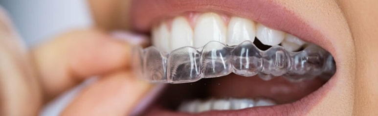Can Invisalign Fix Severe Misalignment? Understanding Its Limits